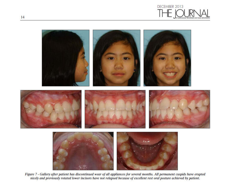 Reversing Retractive Orthodontics with Biobloc Orthotropics - Face ...