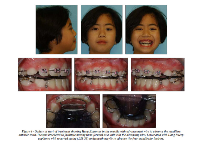 Reversing Retractive Orthodontics with Biobloc Orthotropics - Face ...